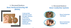 Bone Anchored Hearing Aids – Deaf and Hard of Hearing Team