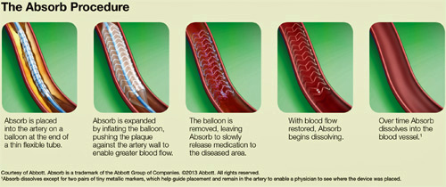 bio absorbable coronary stents – SWC Healthcare