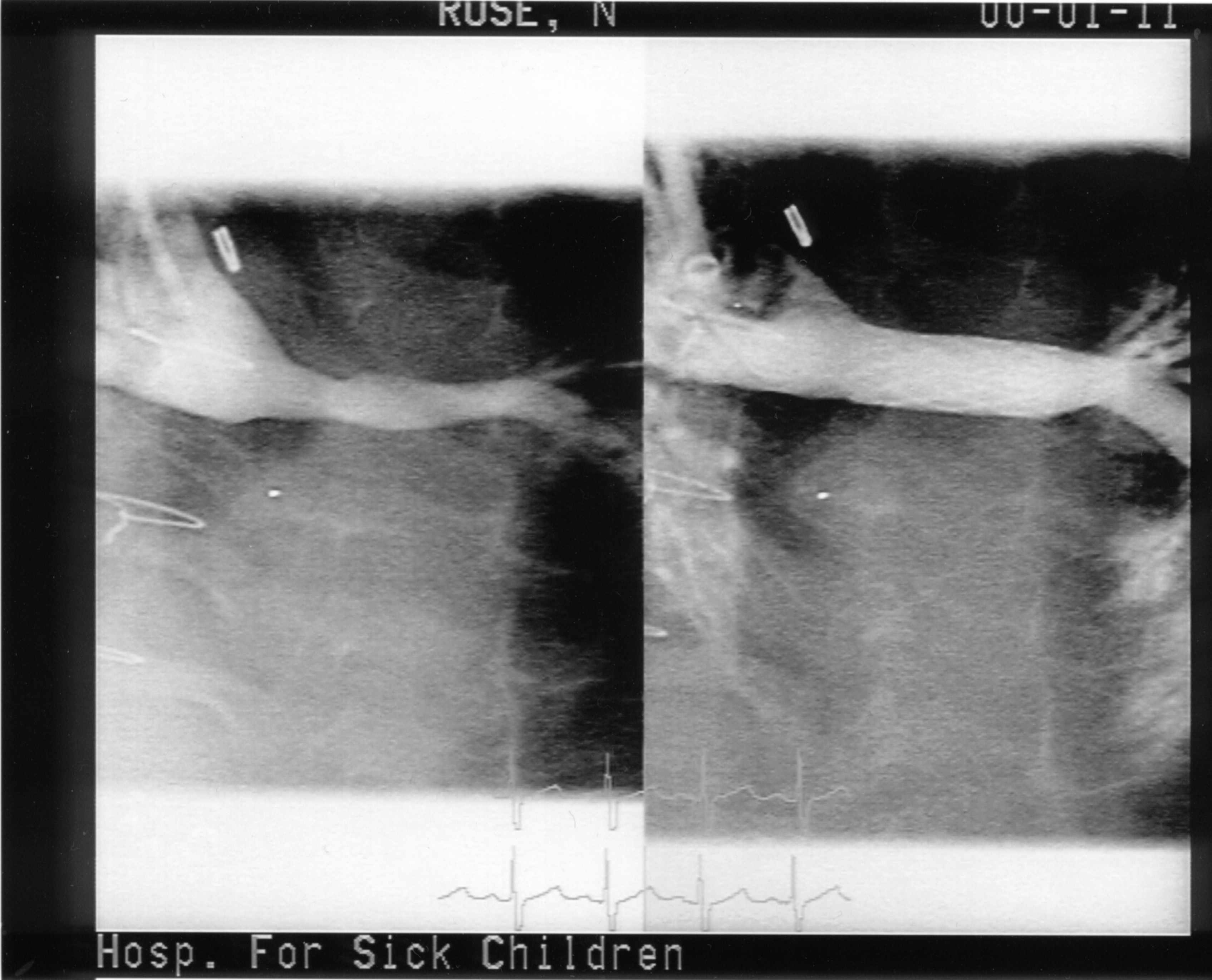 bio absorbable coronary stents – SWC Healthcare
