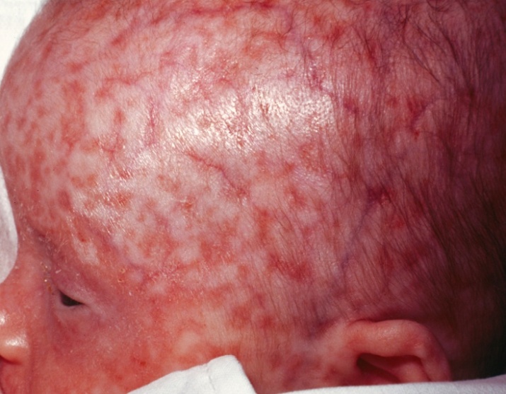 Systemic Lupus Erythematosus – SWC Healthcare